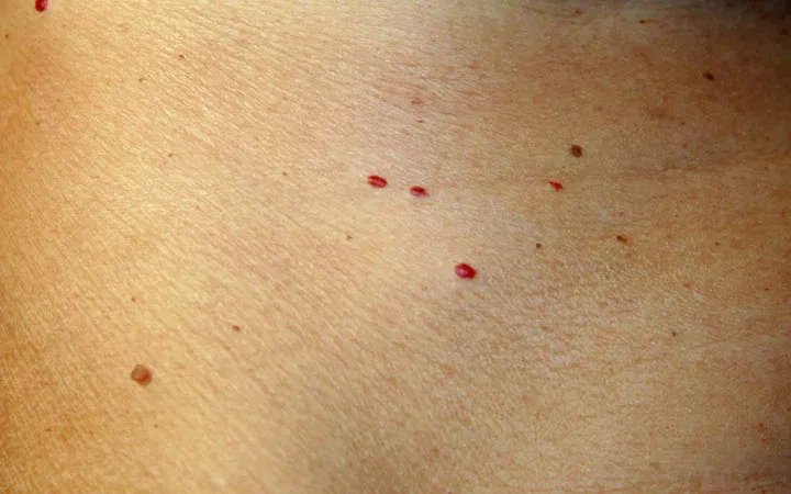 Explore 10+ common reasons for red spots on the skin