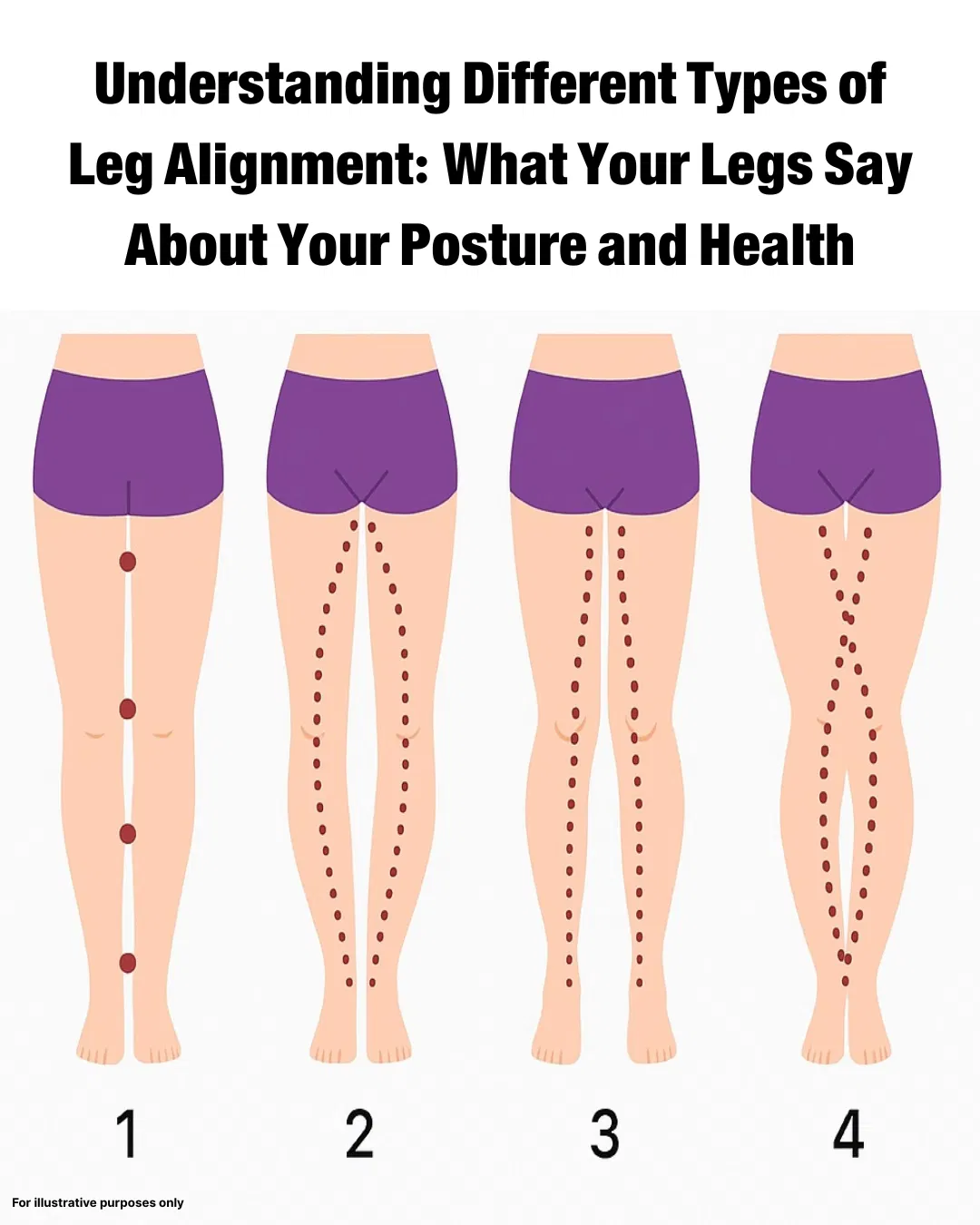 Understanding Different Types of Leg Alignment: What Your Legs Say ...