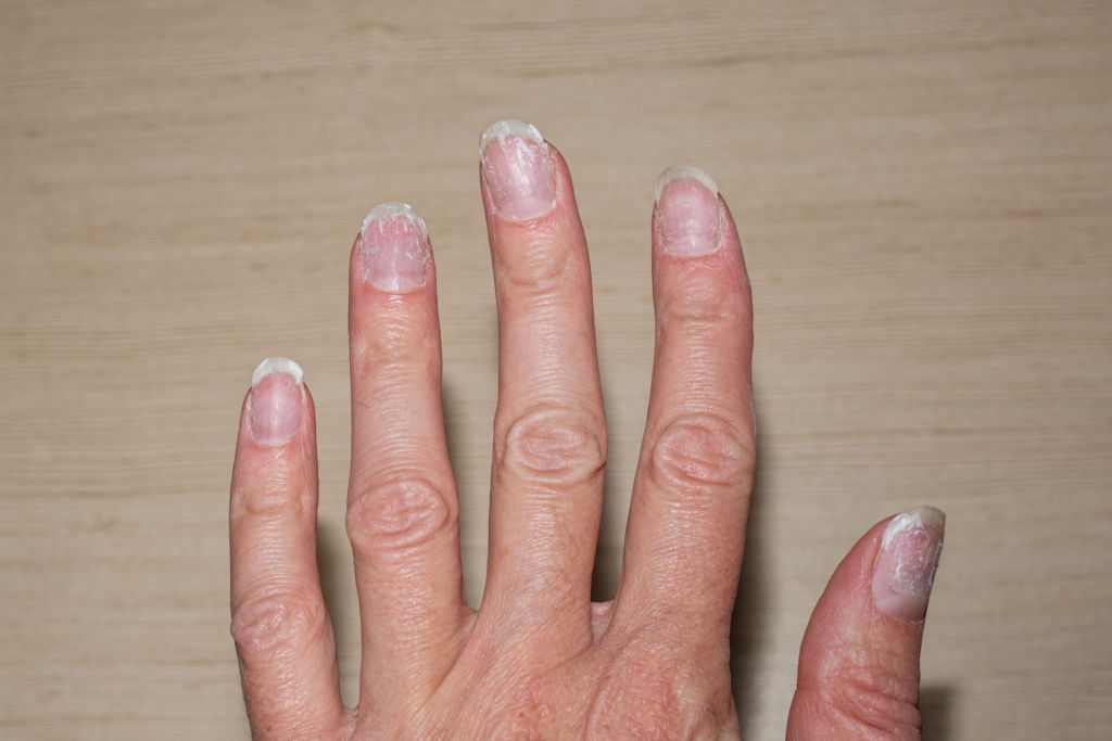 Weak or Brittle Nails: What Your Body Is Trying to Tell You
